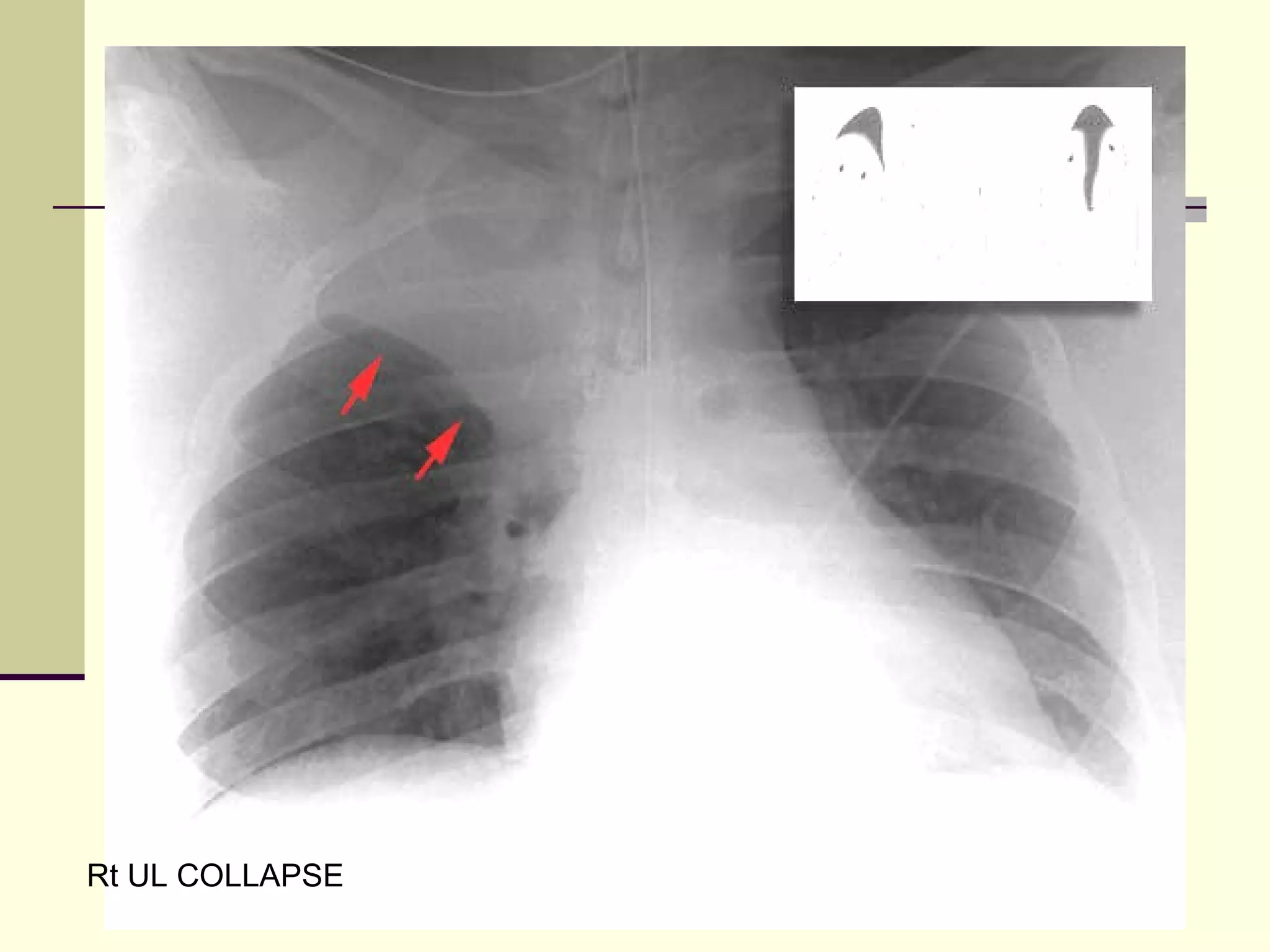 Chest x ray pathology | PPT