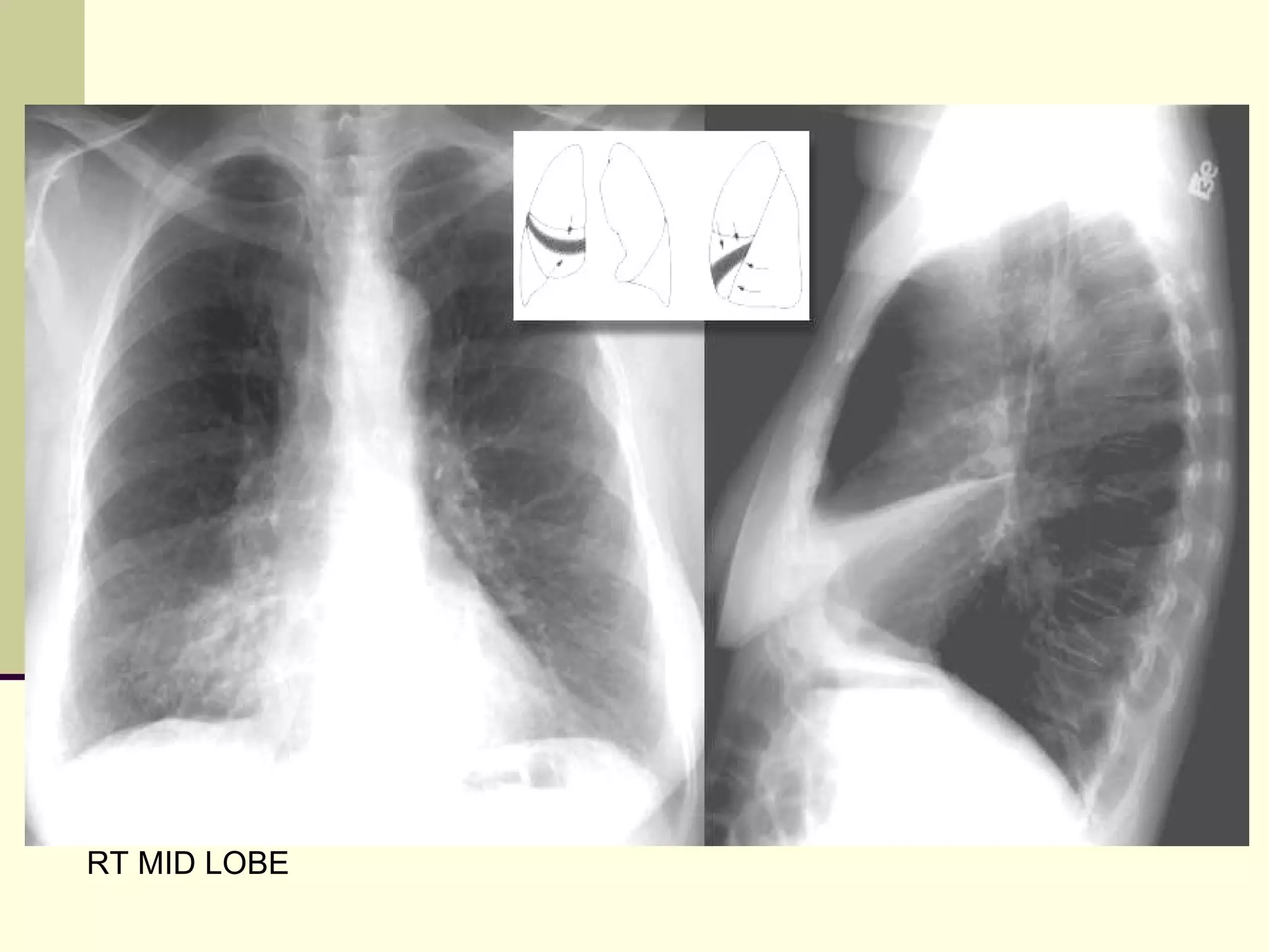 Chest x ray pathology | PPT | Lung and Respiratory Health | Diseases ...