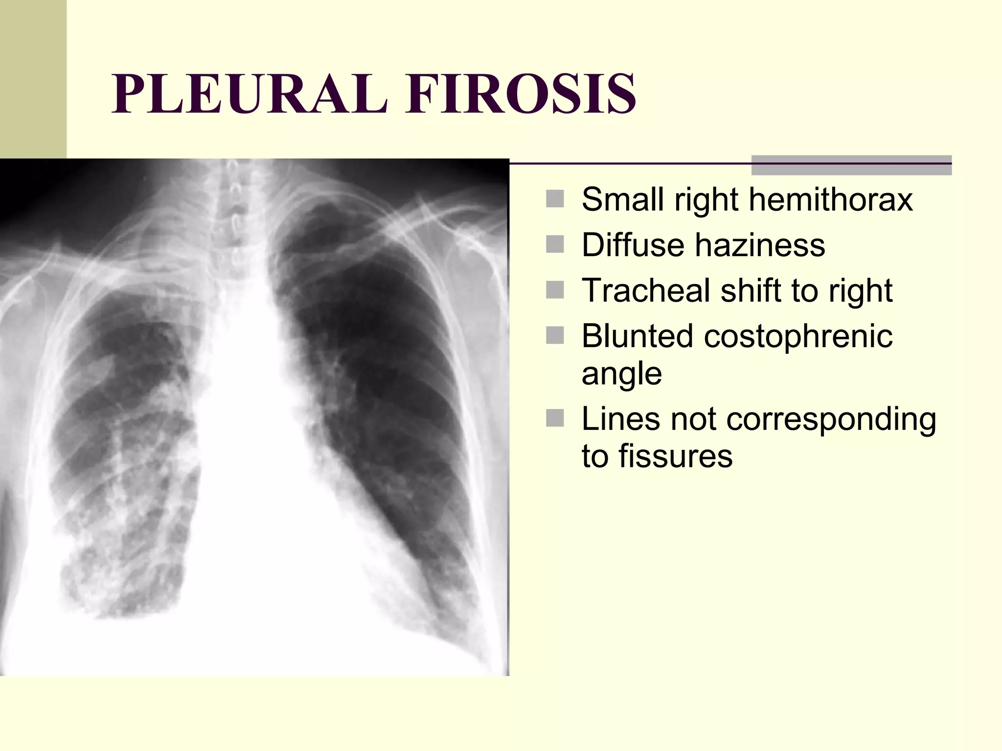 Chest x ray pathology | PPT | Lung and Respiratory Health | Diseases ...