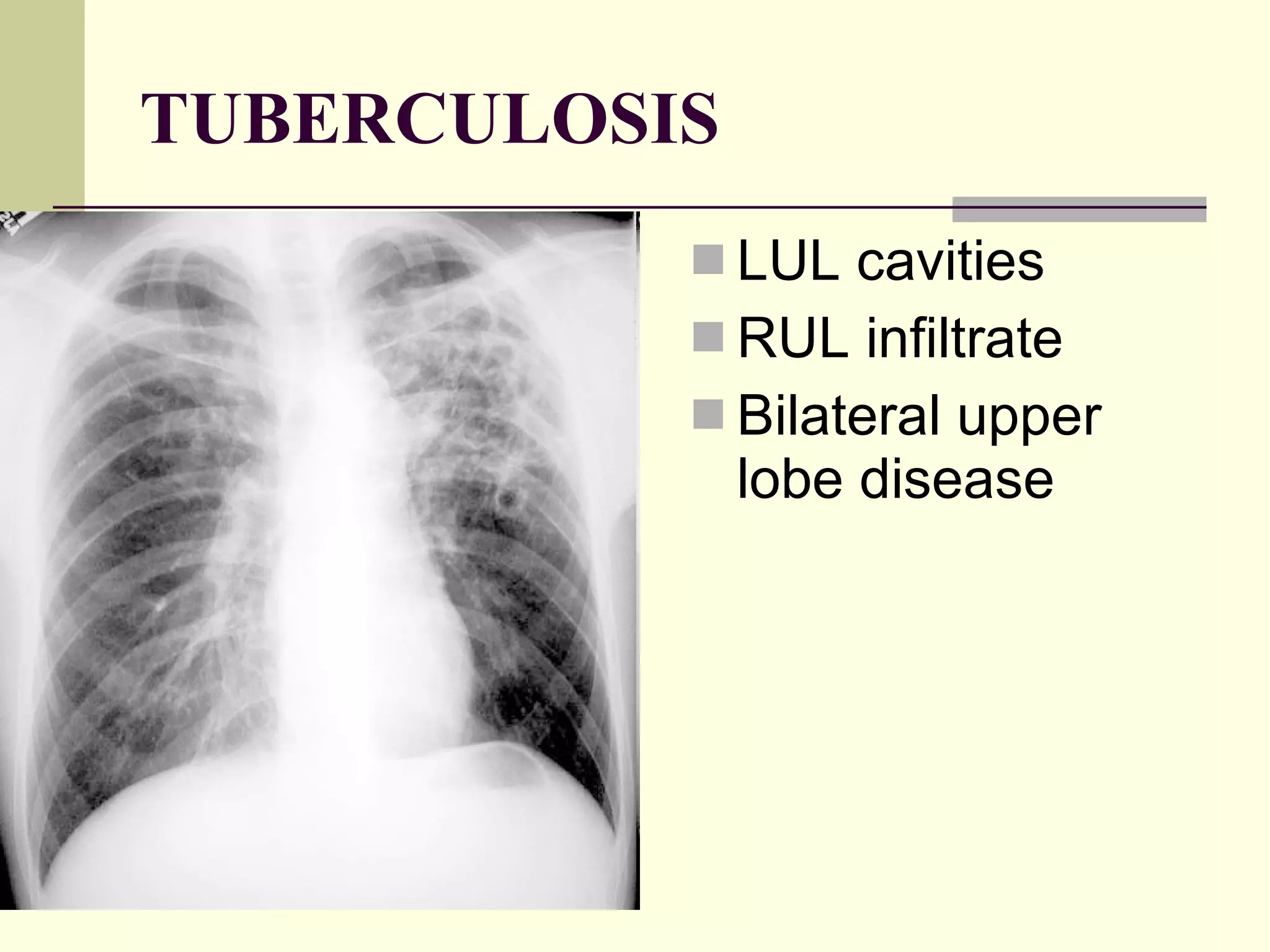 Chest x ray pathology | PPT
