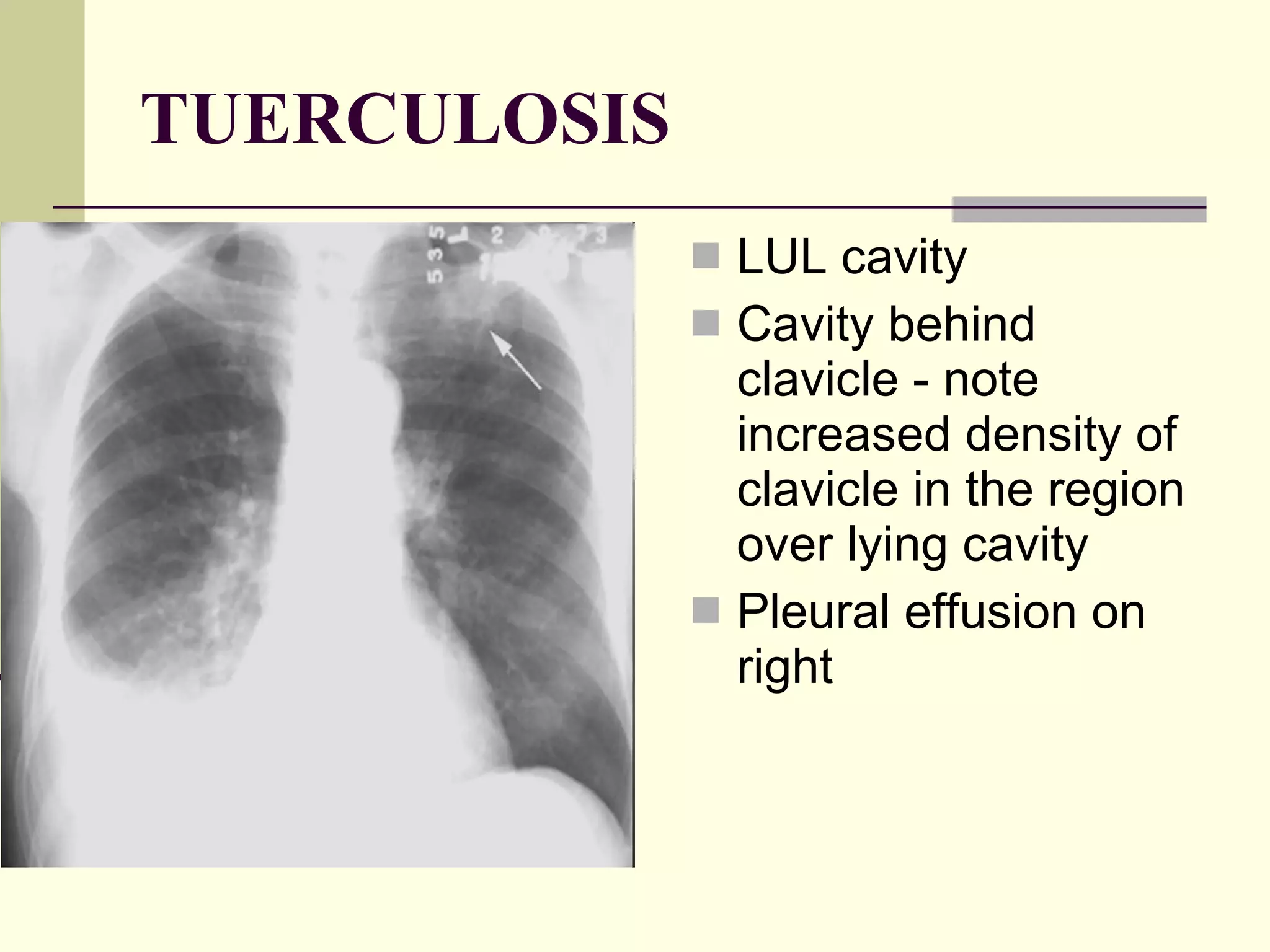 Chest x ray pathology | PPT
