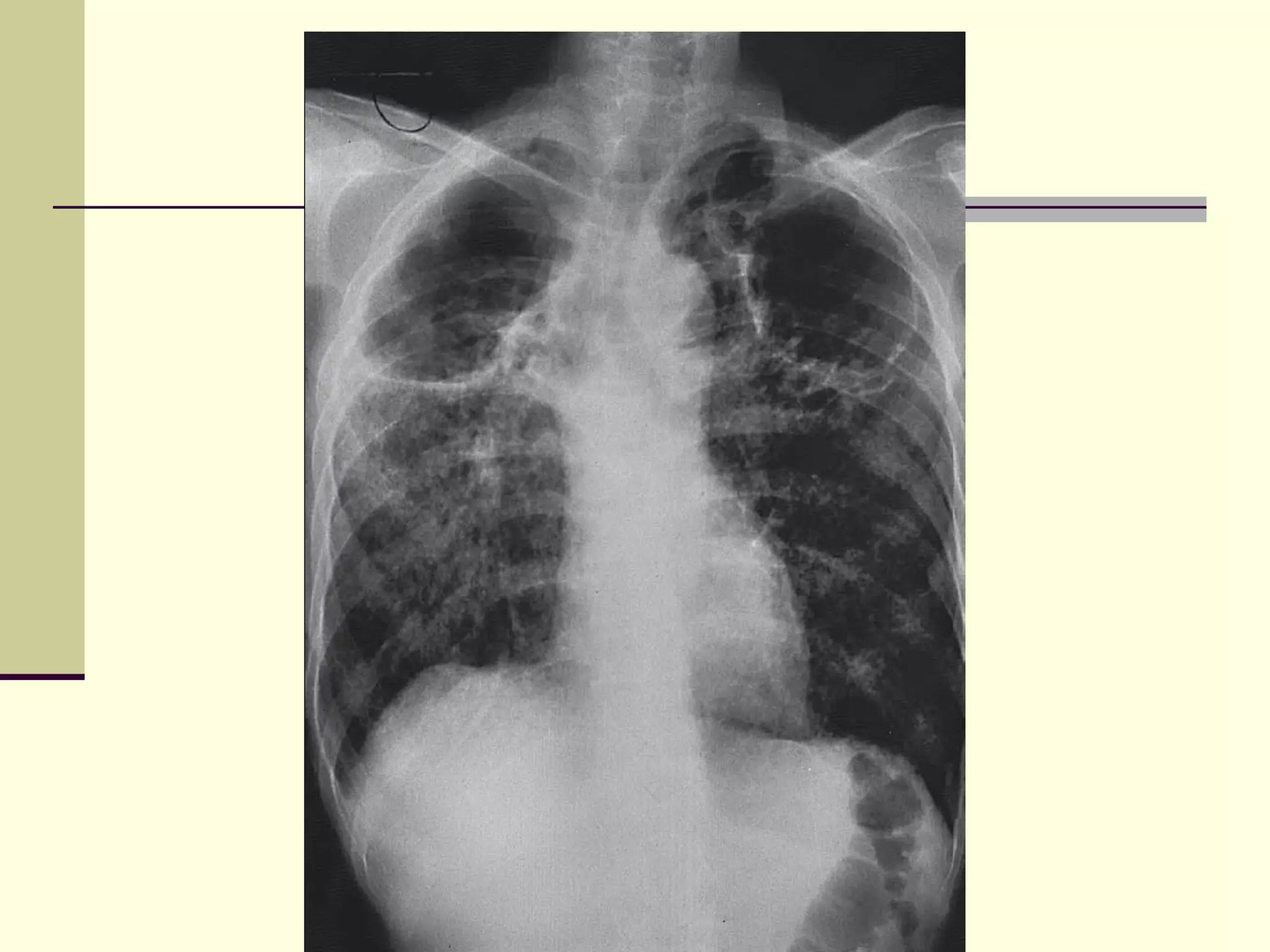 Chest x ray pathology | PPT | Lung and Respiratory Health | Diseases ...