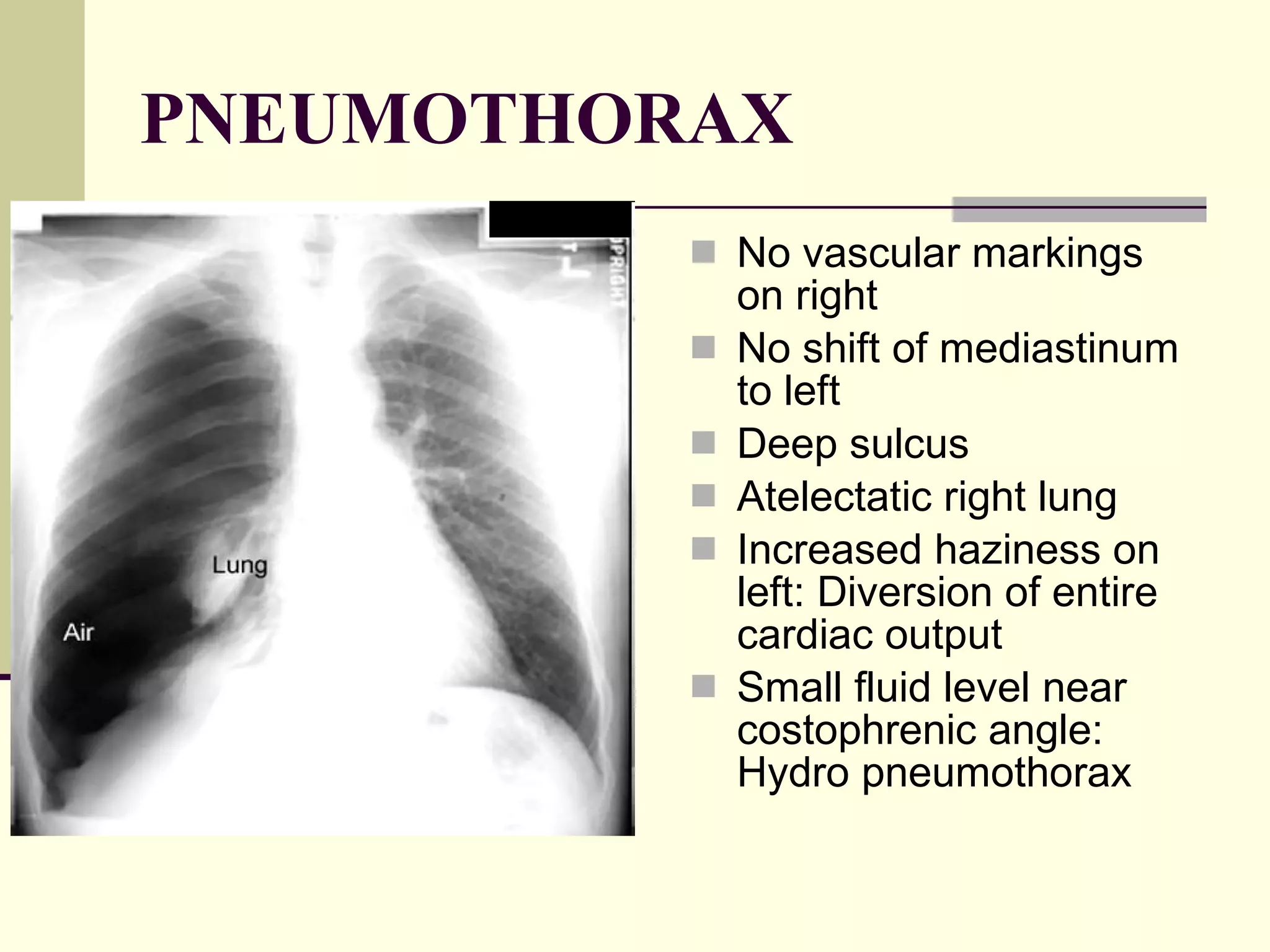 Chest x ray pathology | PPT