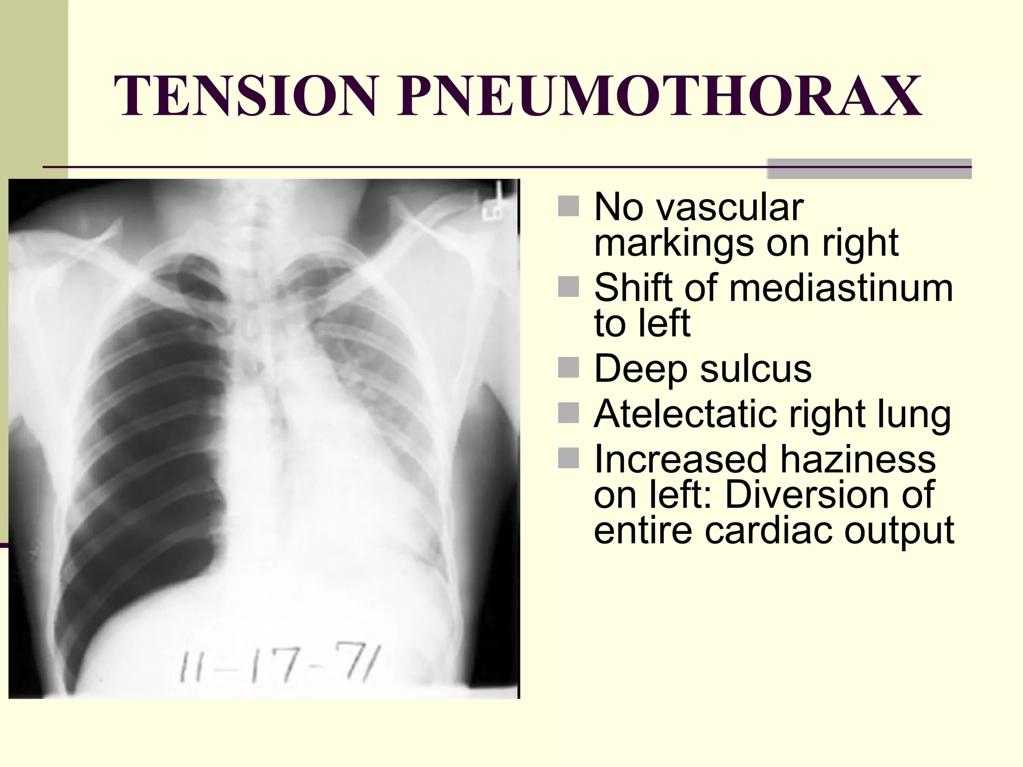 Chest x ray pathology | PPT