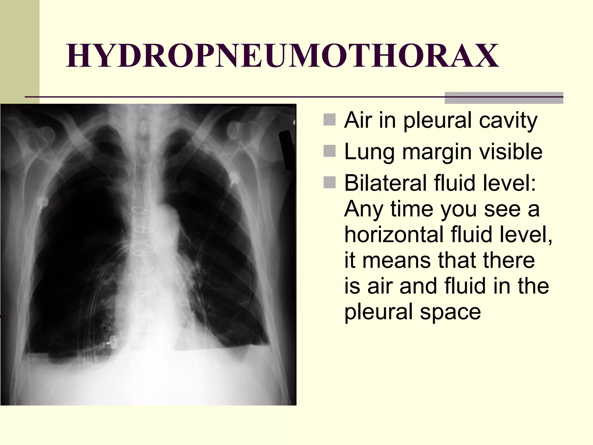 Chest x ray pathology | PPT