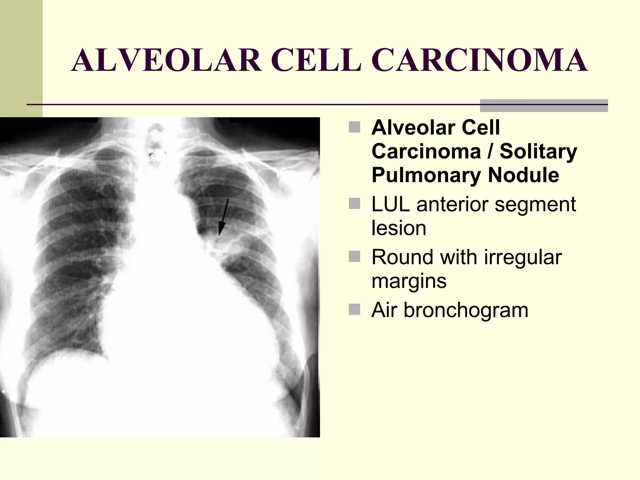 Chest x ray pathology | PPT