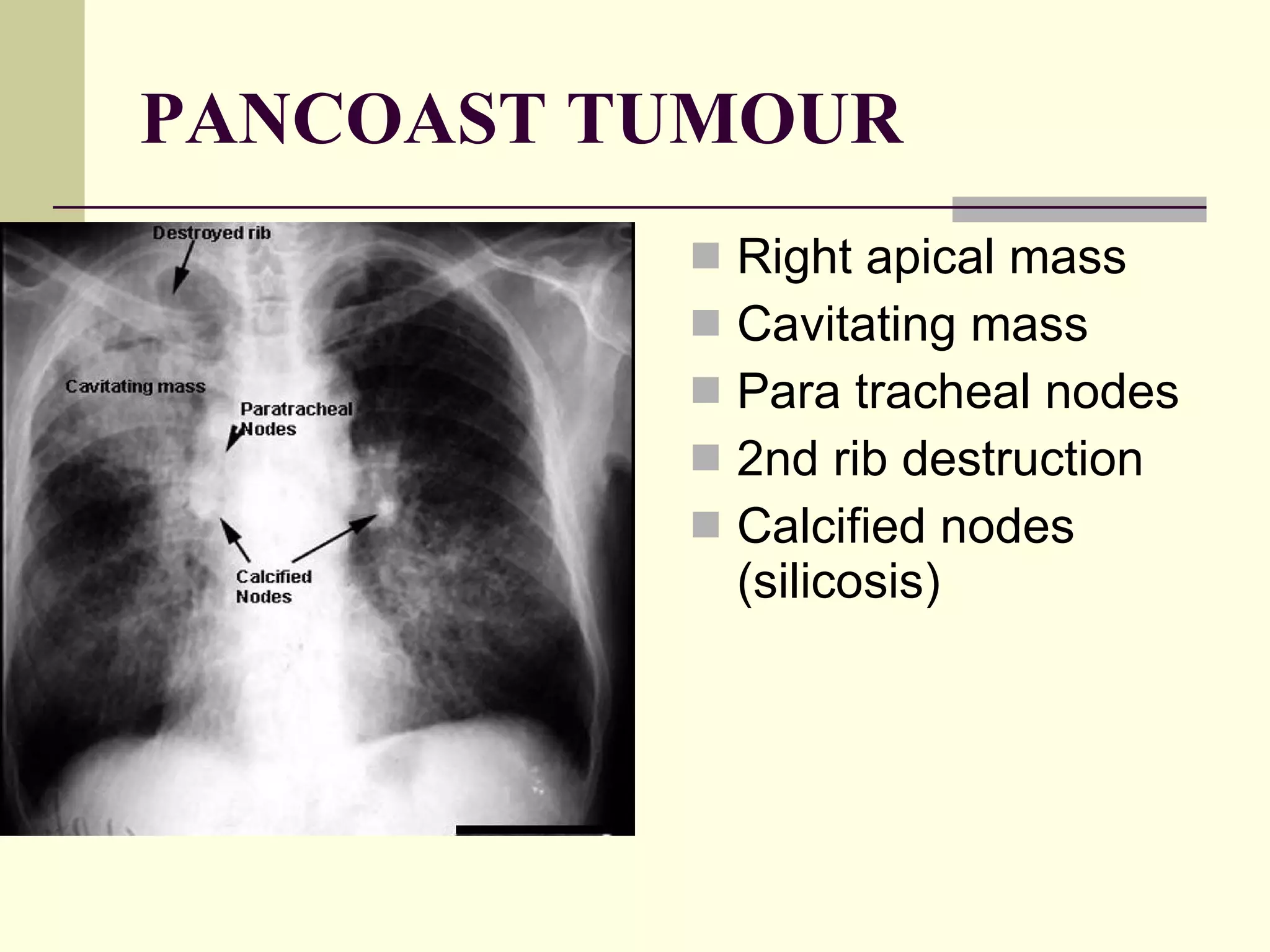 Chest x ray pathology | PPT | Lung and Respiratory Health | Diseases ...
