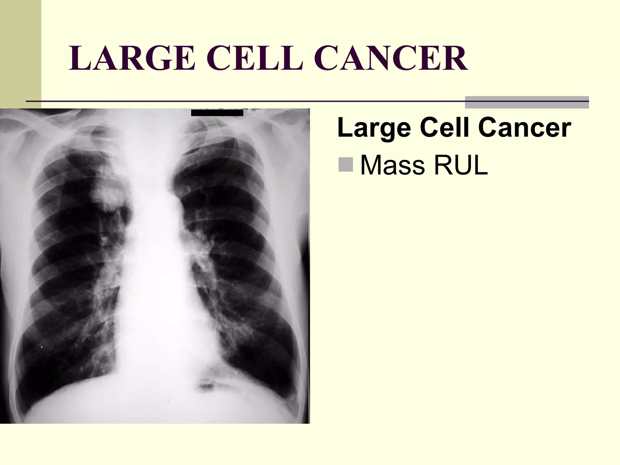 Chest x ray pathology | PPT | Lung and Respiratory Health | Diseases ...