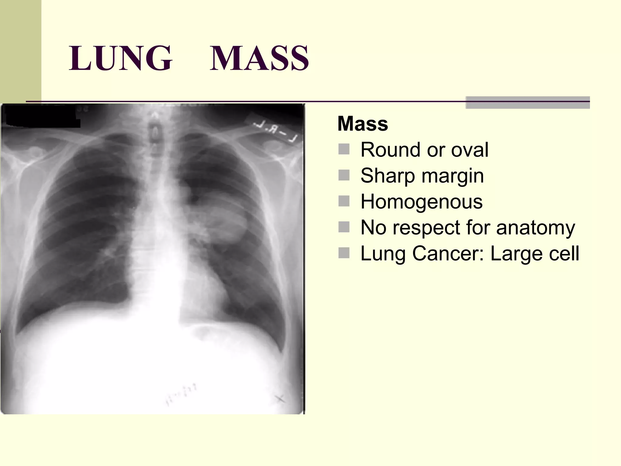 Chest x ray pathology | PPT