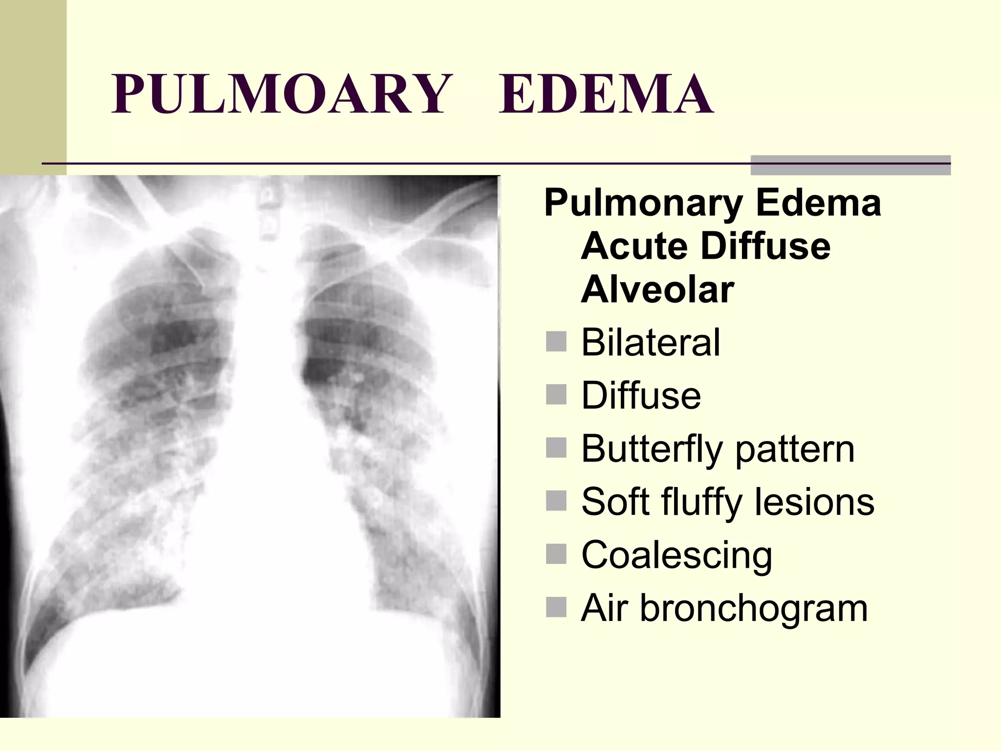 Chest x ray pathology | PPT