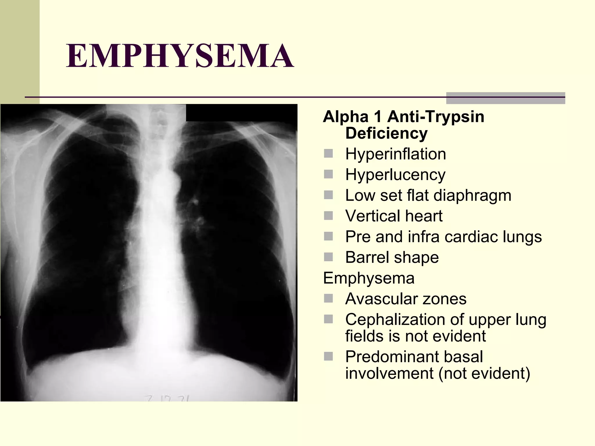 Chest x ray pathology | PPT