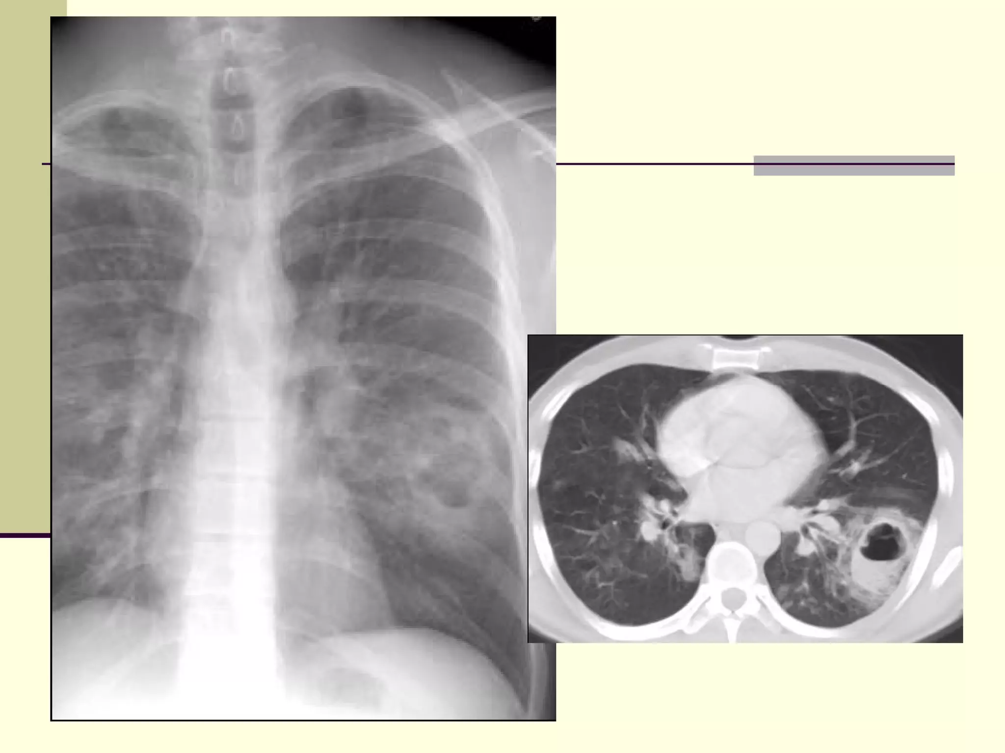 Chest x ray pathology | PPT
