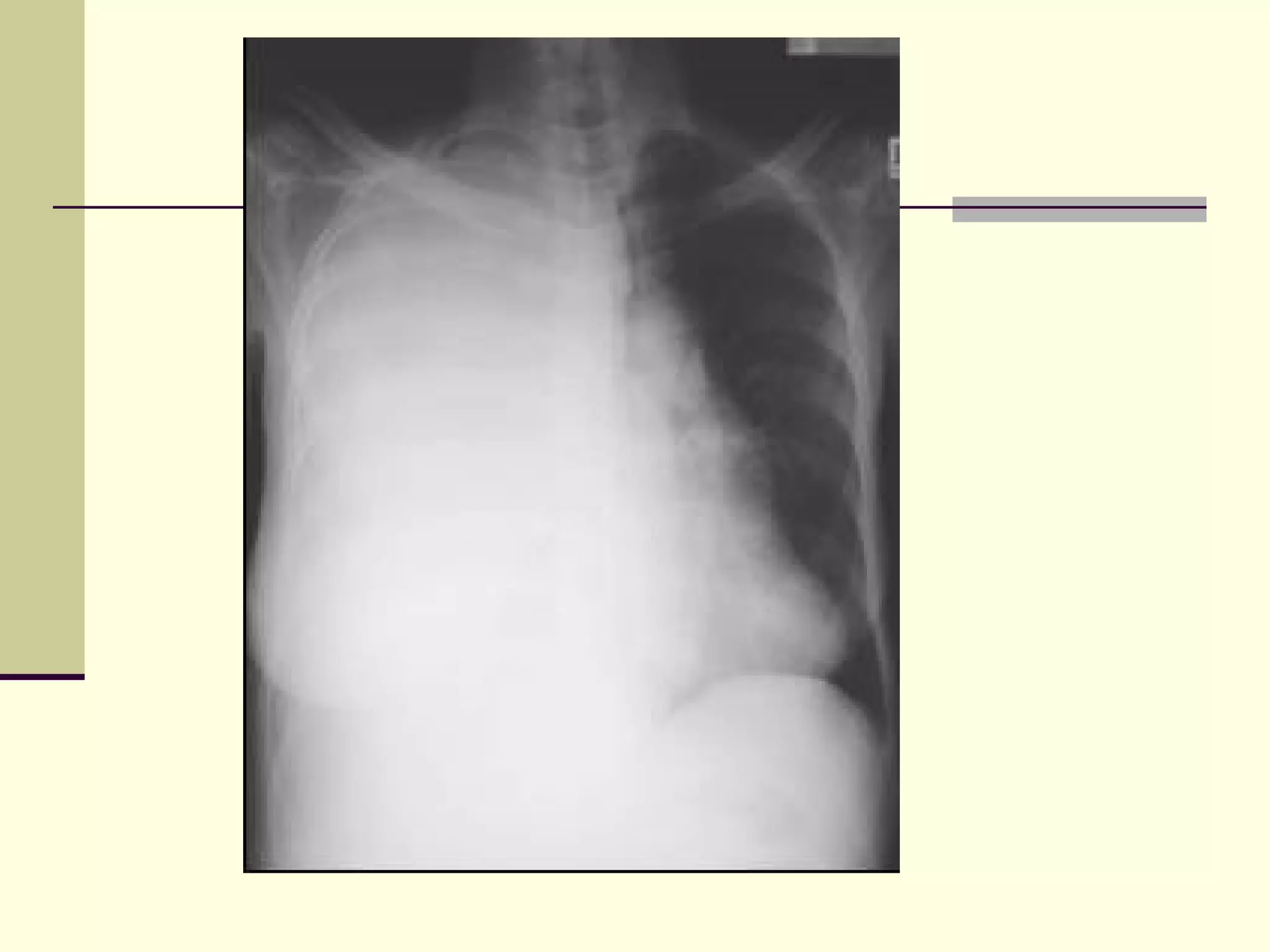 Chest x ray pathology | PPT