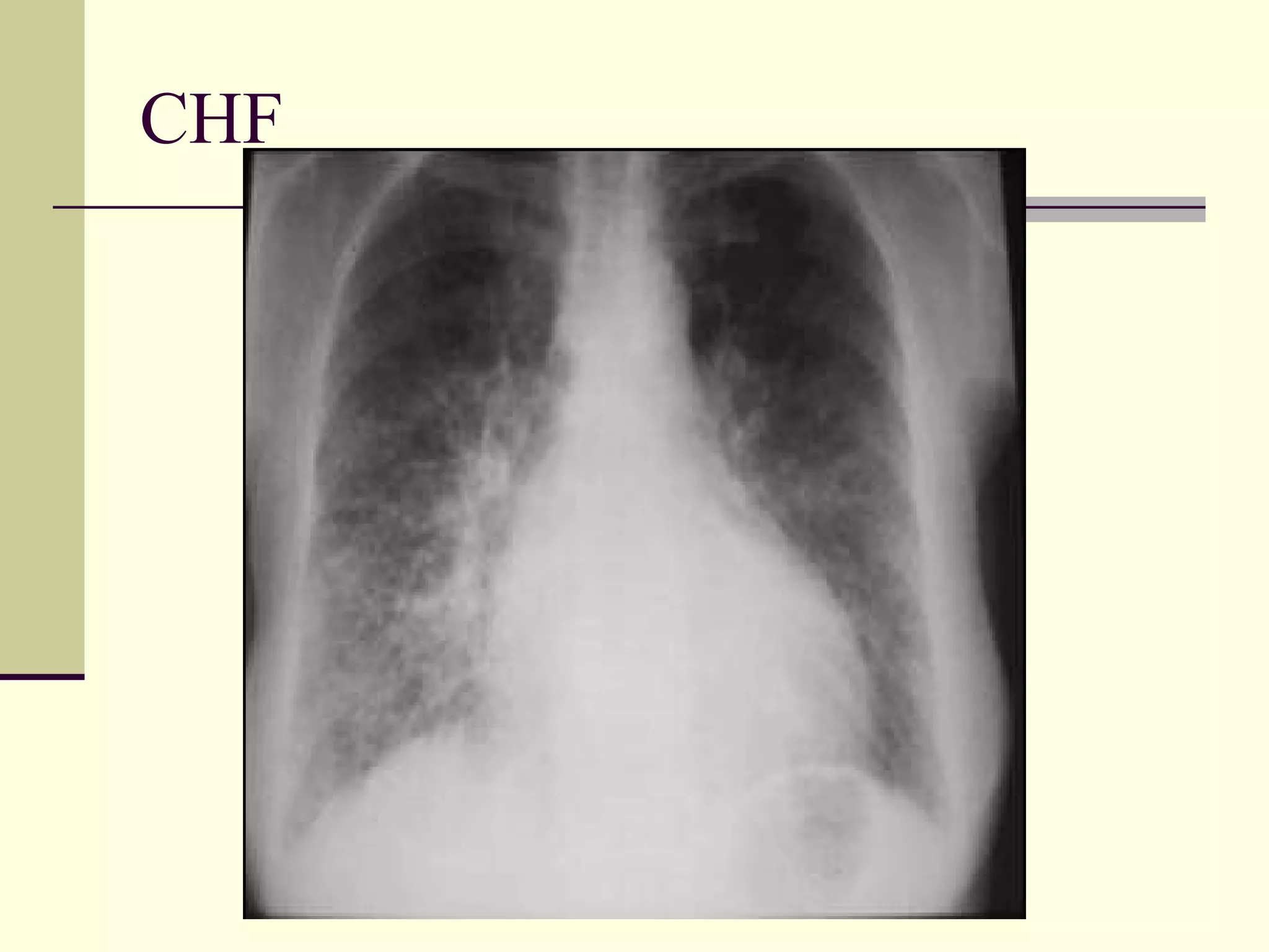 Chest x ray pathology | PPT