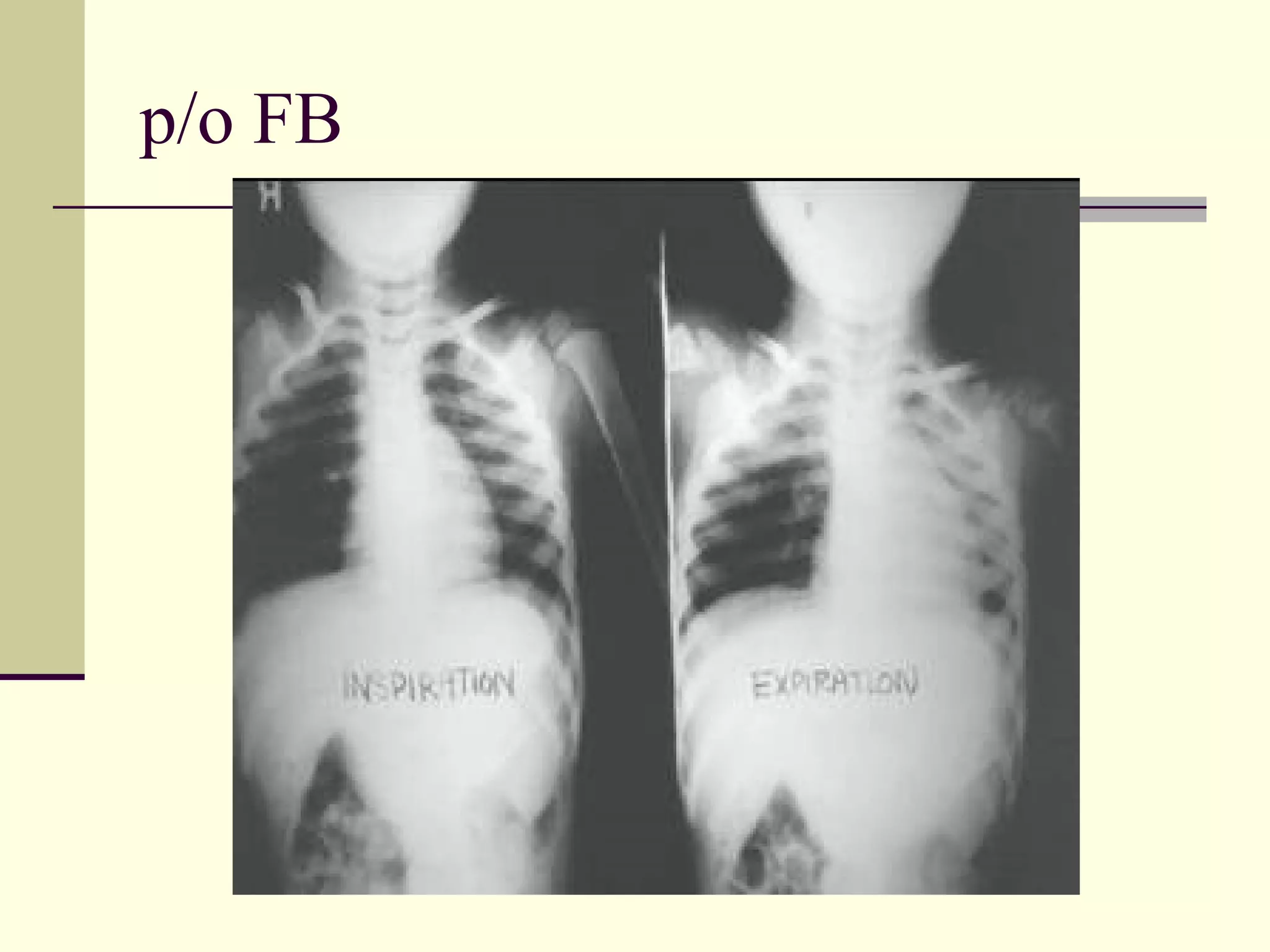 Chest x ray pathology | PPT