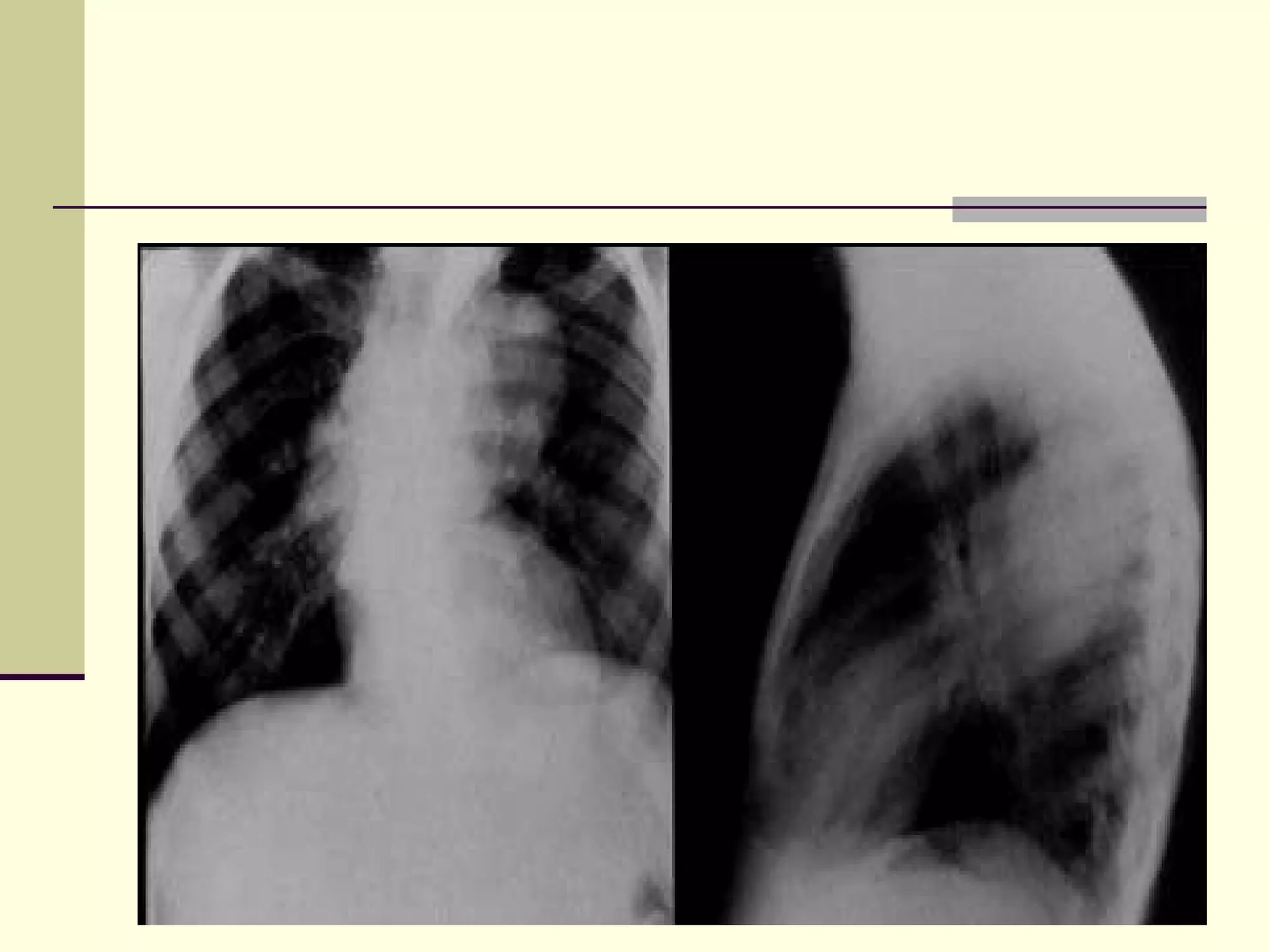 Chest x ray pathology | PPT