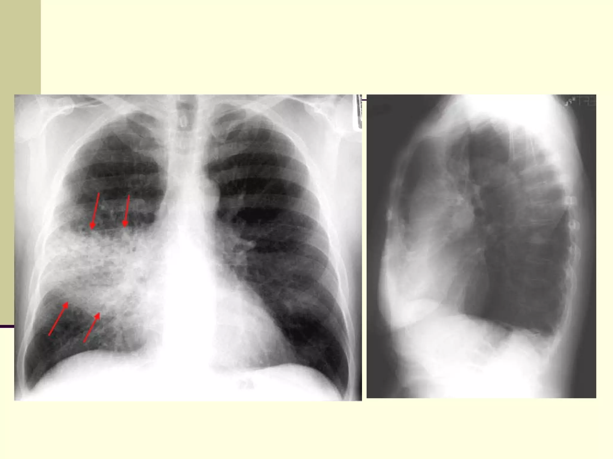 Chest x ray pathology | PPT