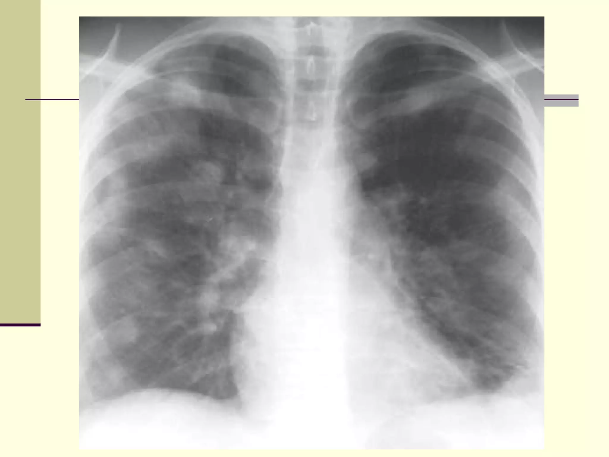 Chest x ray pathology | PPT