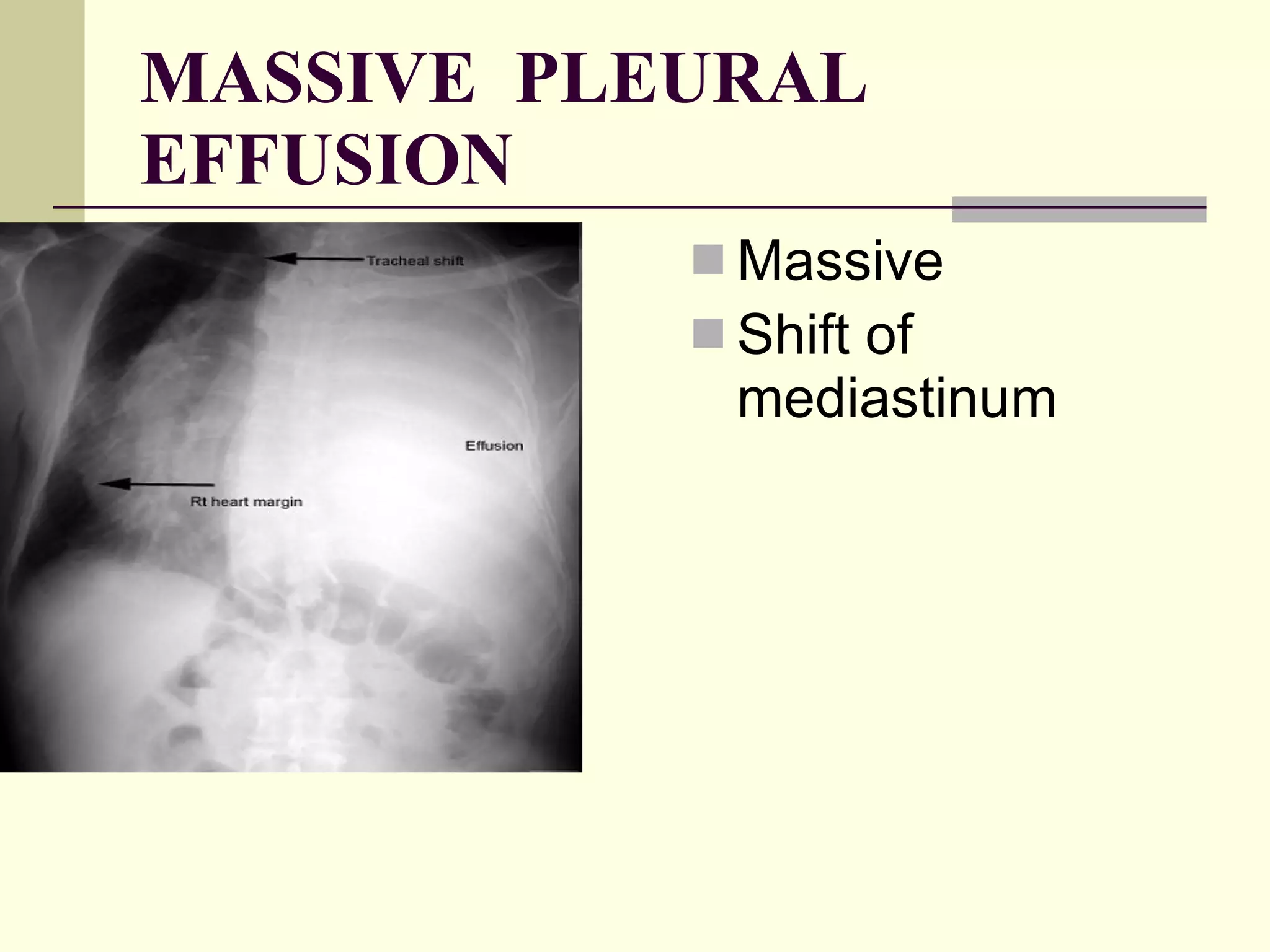 Chest x ray pathology | PPT