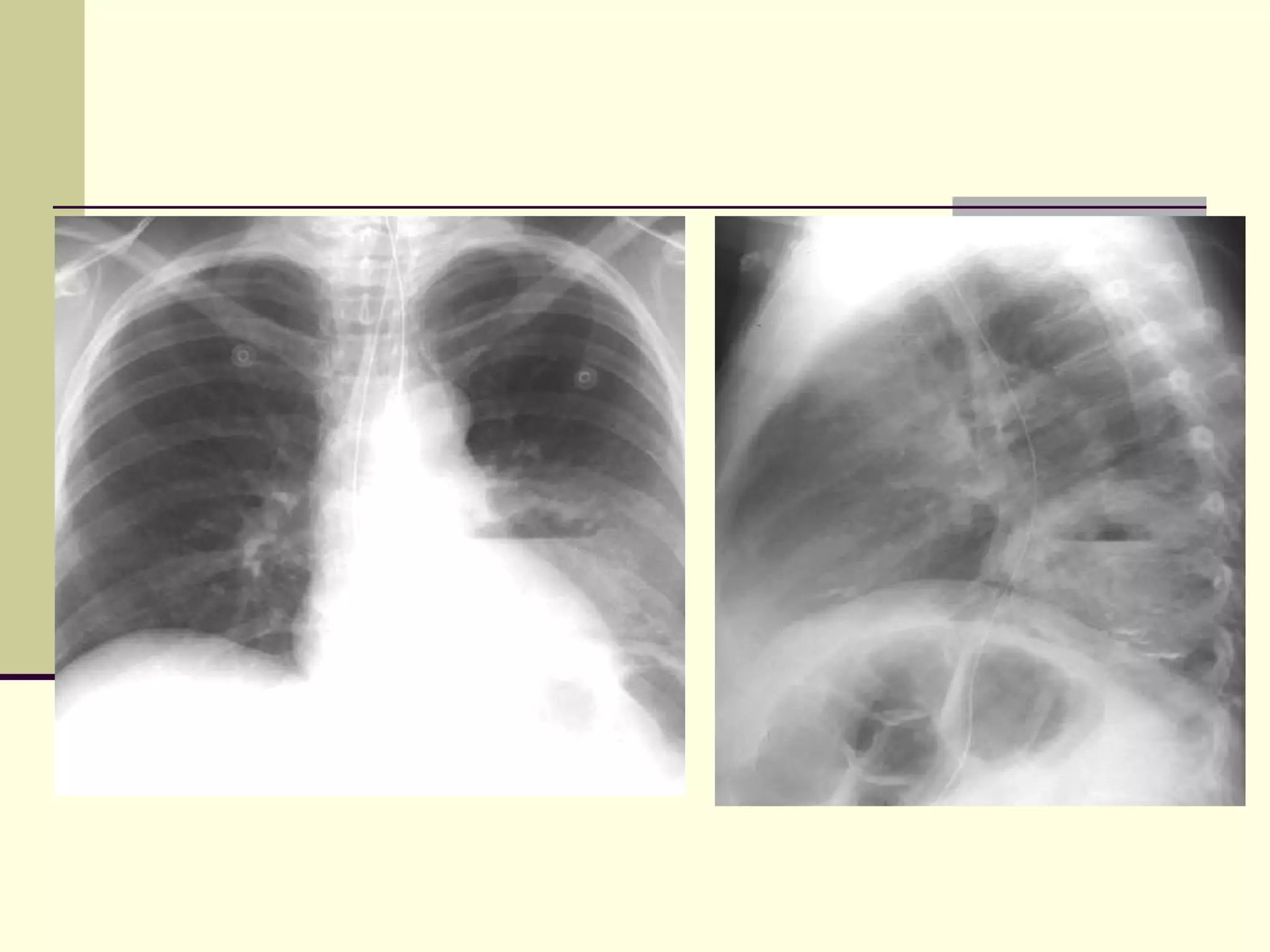 Chest x ray pathology | PPT