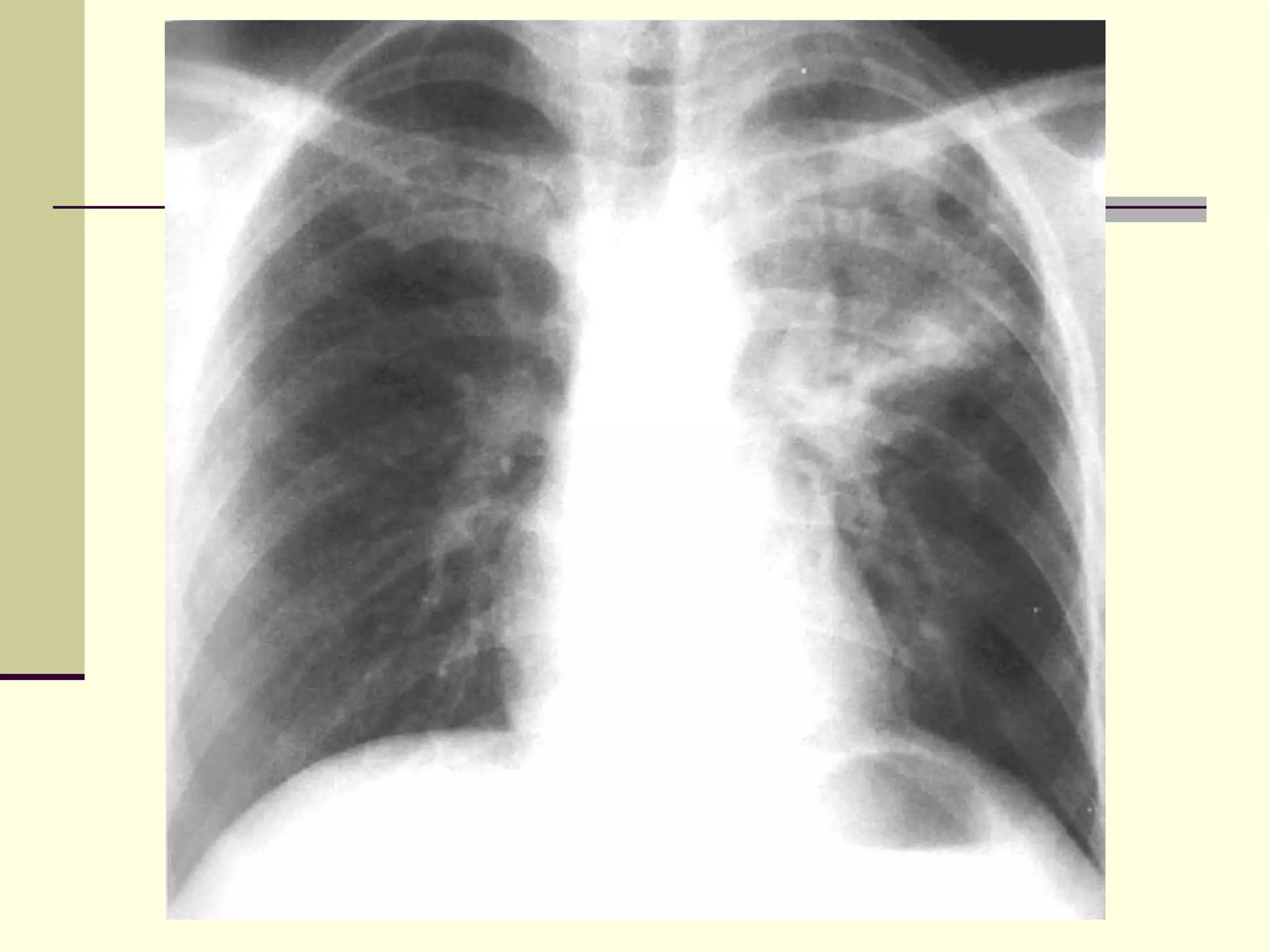 Chest x ray pathology | PPT