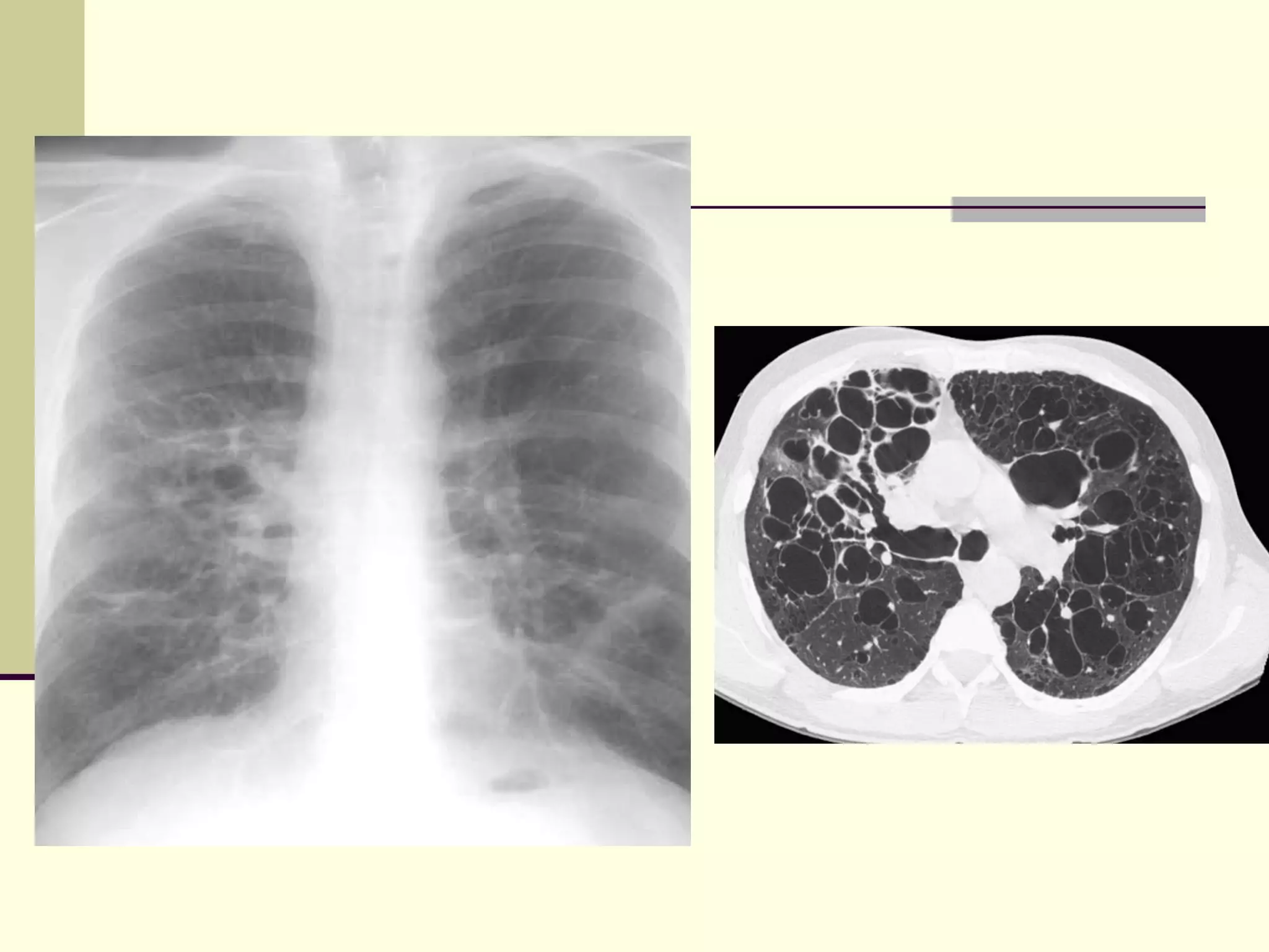 Chest x ray pathology | PPT