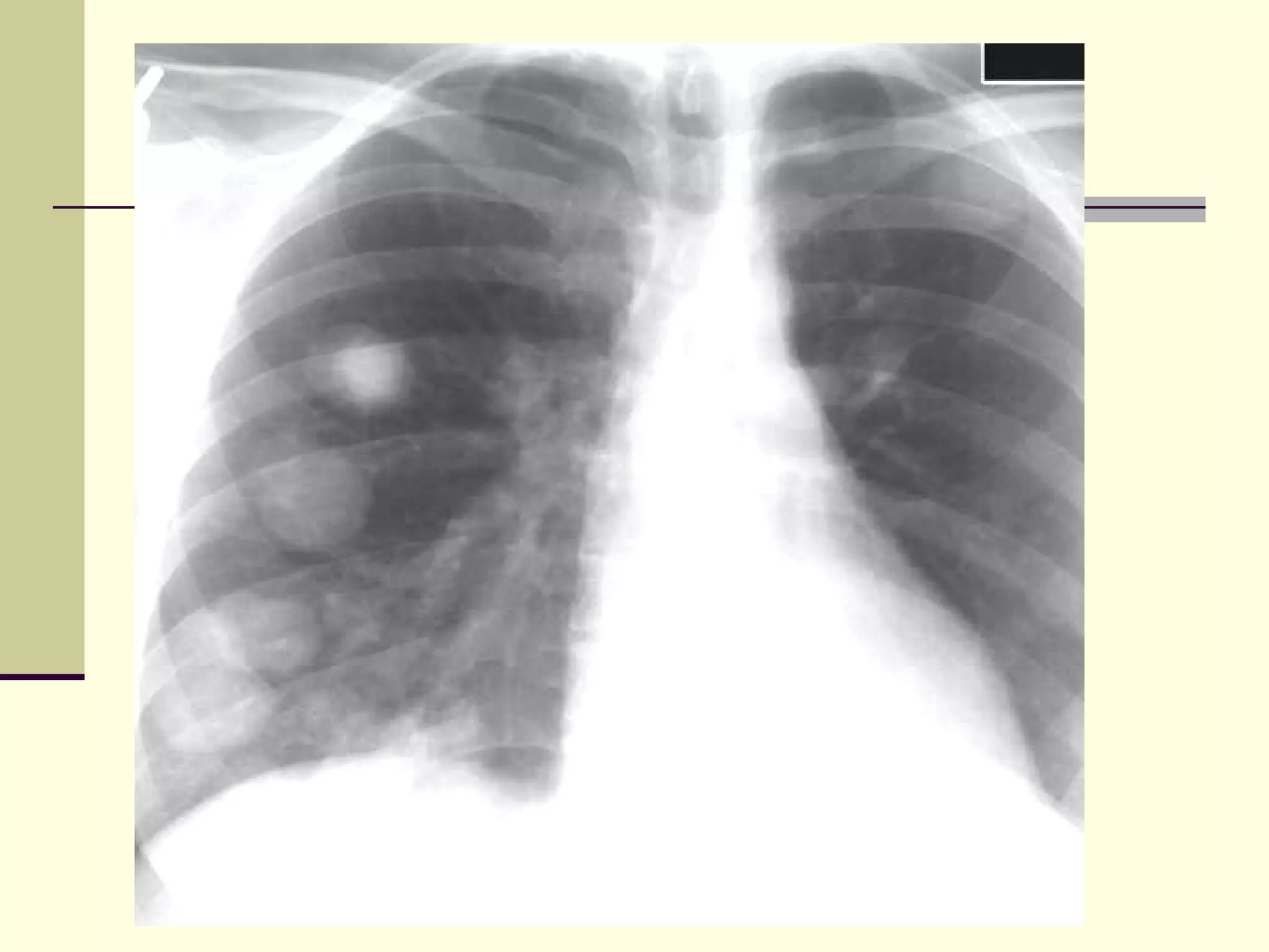 Chest x ray pathology | PPT