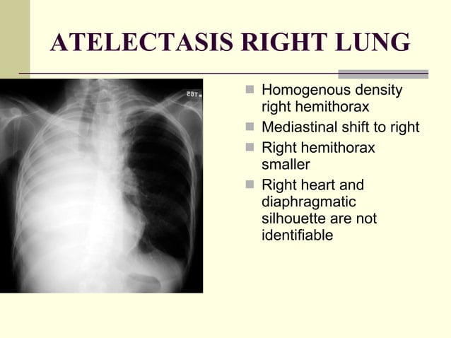 Chest x ray pathology | PPT | Lung and Respiratory Health | Diseases ...