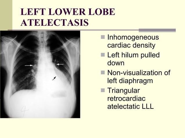Chest x ray pathology | PPT | Lung and Respiratory Health | Diseases ...