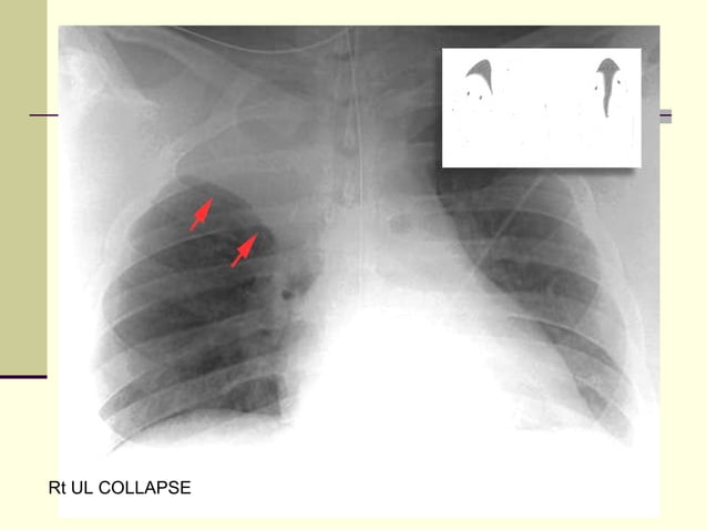Chest x ray pathology | PPT | Lung and Respiratory Health | Diseases ...
