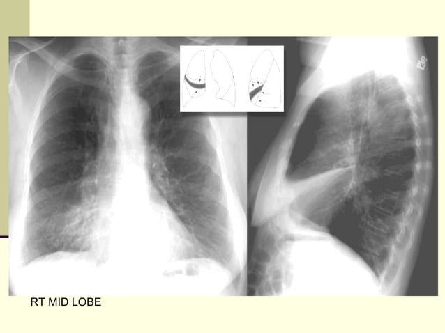 Chest x ray pathology | PPT | Lung and Respiratory Health | Diseases ...