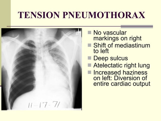 Chest x ray pathology | PPT | Lung and Respiratory Health | Diseases ...