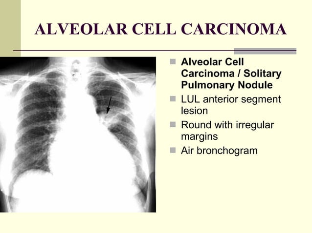 Chest x ray pathology | PPT | Lung and Respiratory Health | Diseases ...