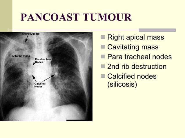 Chest x ray pathology | PPT | Lung and Respiratory Health | Diseases ...
