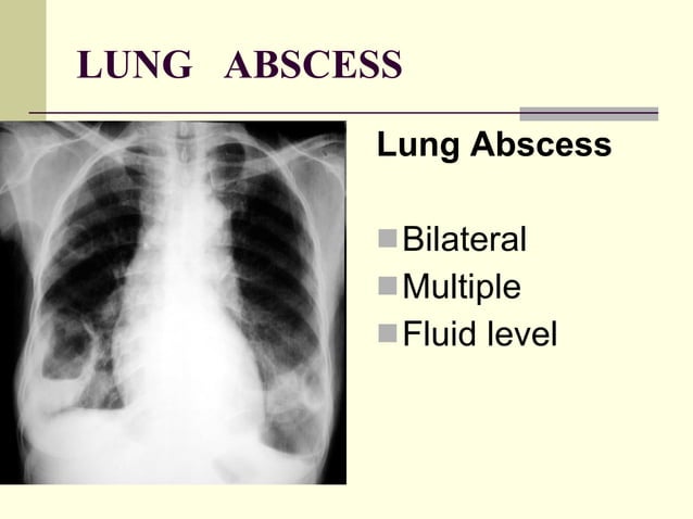Chest x ray pathology | PPT | Lung and Respiratory Health | Diseases ...