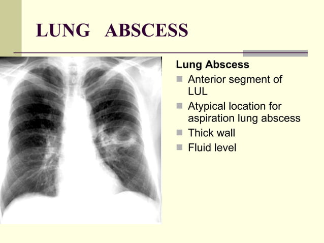 Chest x ray pathology | PPT | Lung and Respiratory Health | Diseases ...