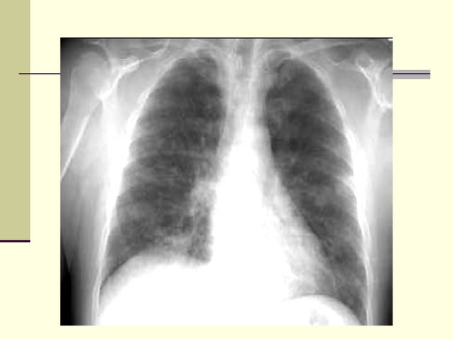 Chest x ray pathology | PPT | Lung and Respiratory Health | Diseases ...