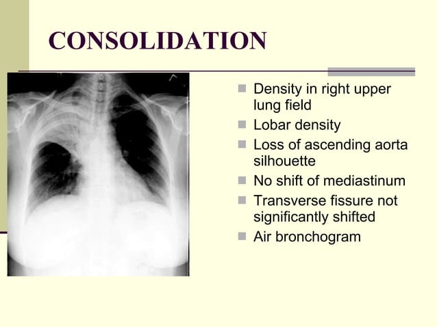 Chest x ray pathology | PPT | Lung and Respiratory Health | Diseases ...