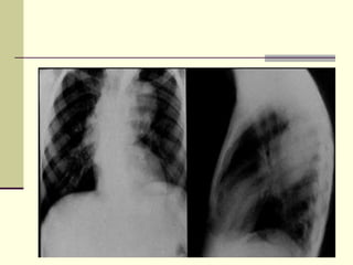Chest x ray pathology | PPT