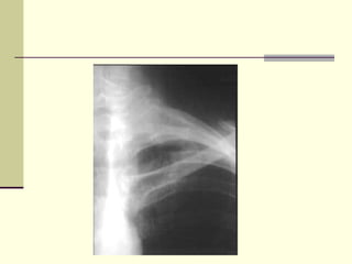 Chest x ray pathology | PPT