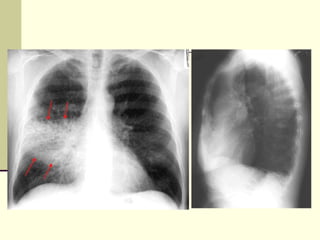Chest x ray pathology | PPT