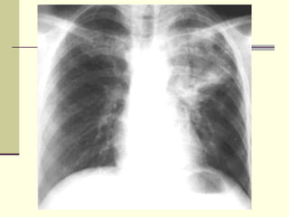 Chest x ray pathology | PPT