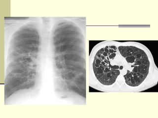 Chest x ray pathology | PPT