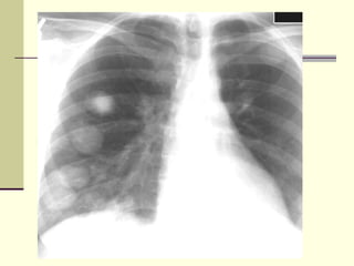 Chest x ray pathology | PPT