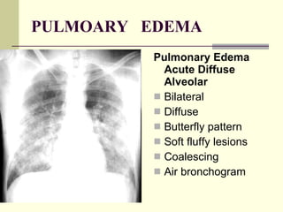 Pulmonary Edema X Ray Butterfly Pattern