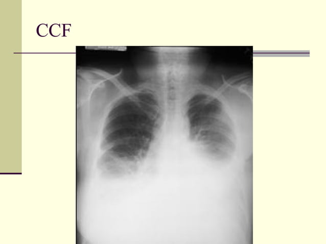 Chest x ray pathology