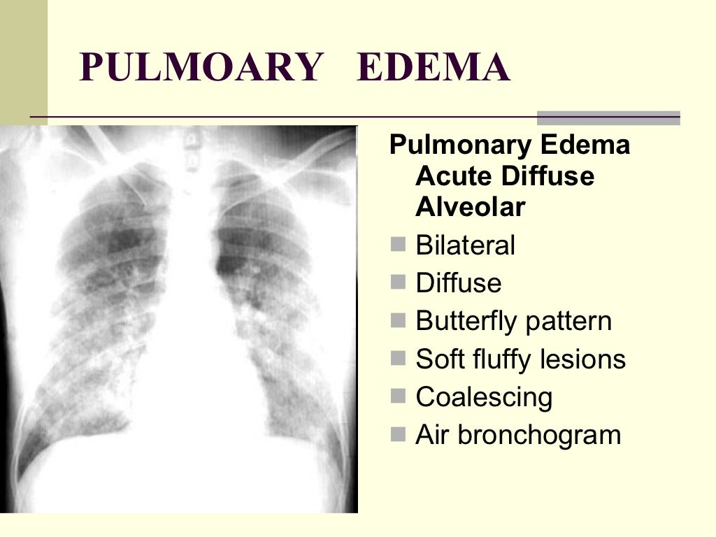 Chest x ray pathology