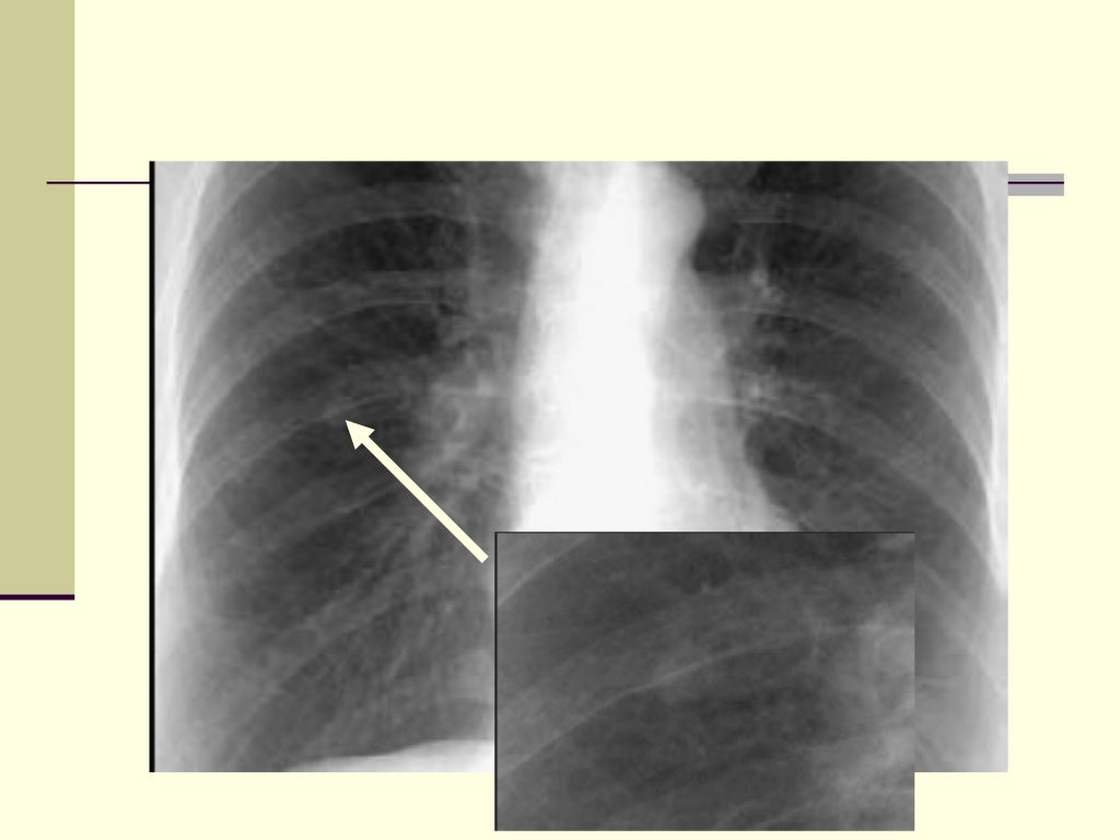 Chest x ray pathology
