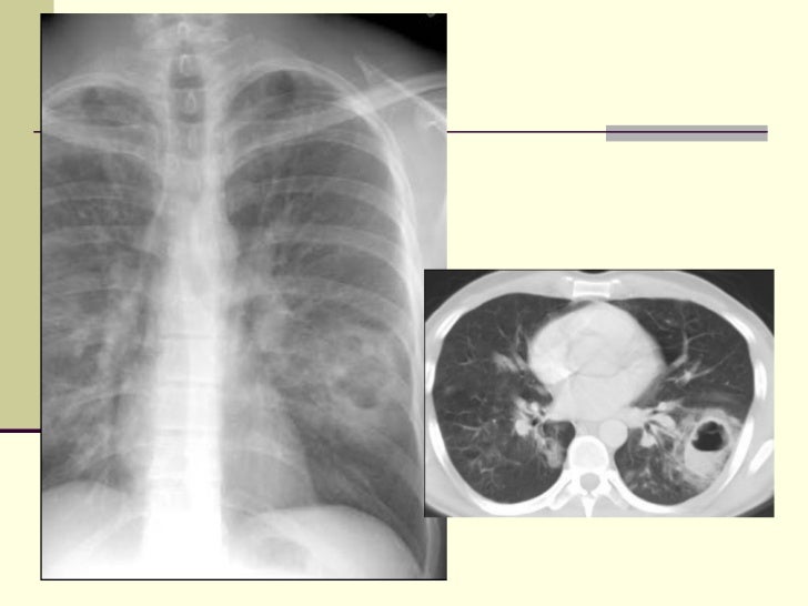 Chest x ray pathology