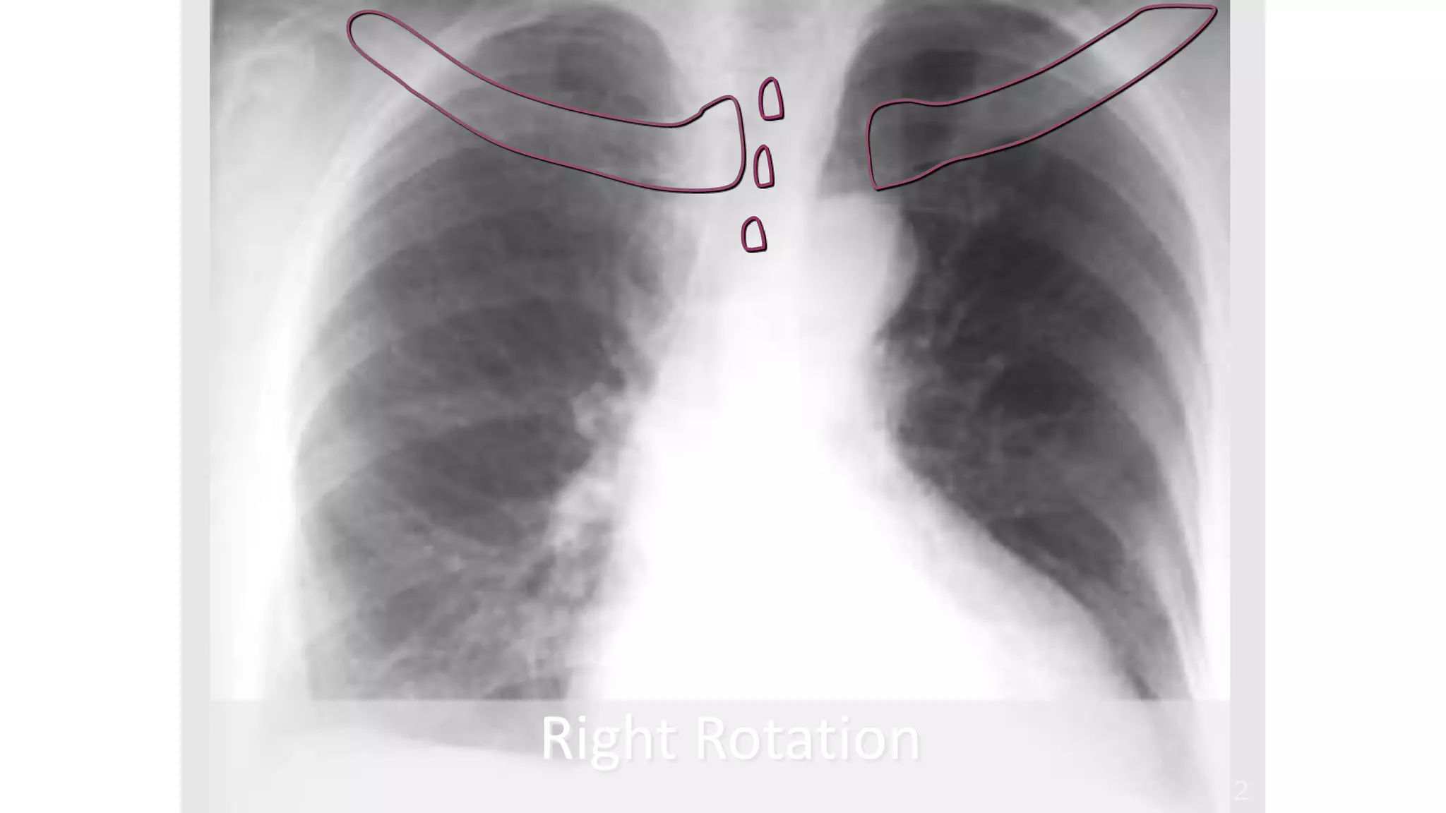 Chest X ray ppt.ppt